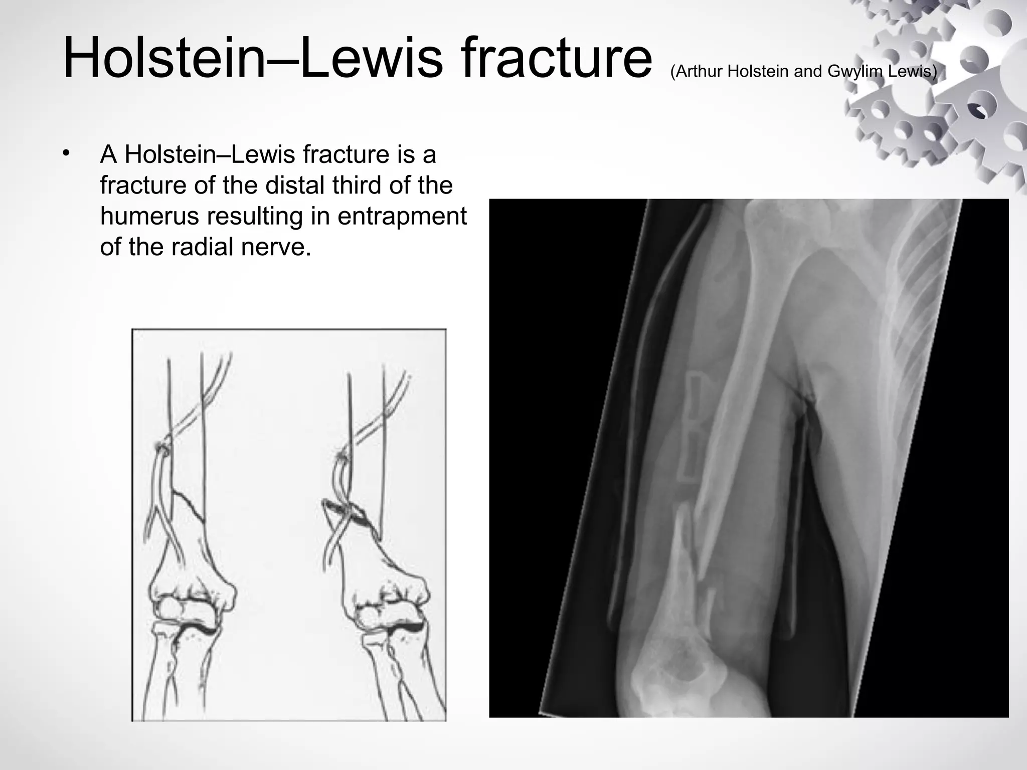Eponymous fractures | PPT
