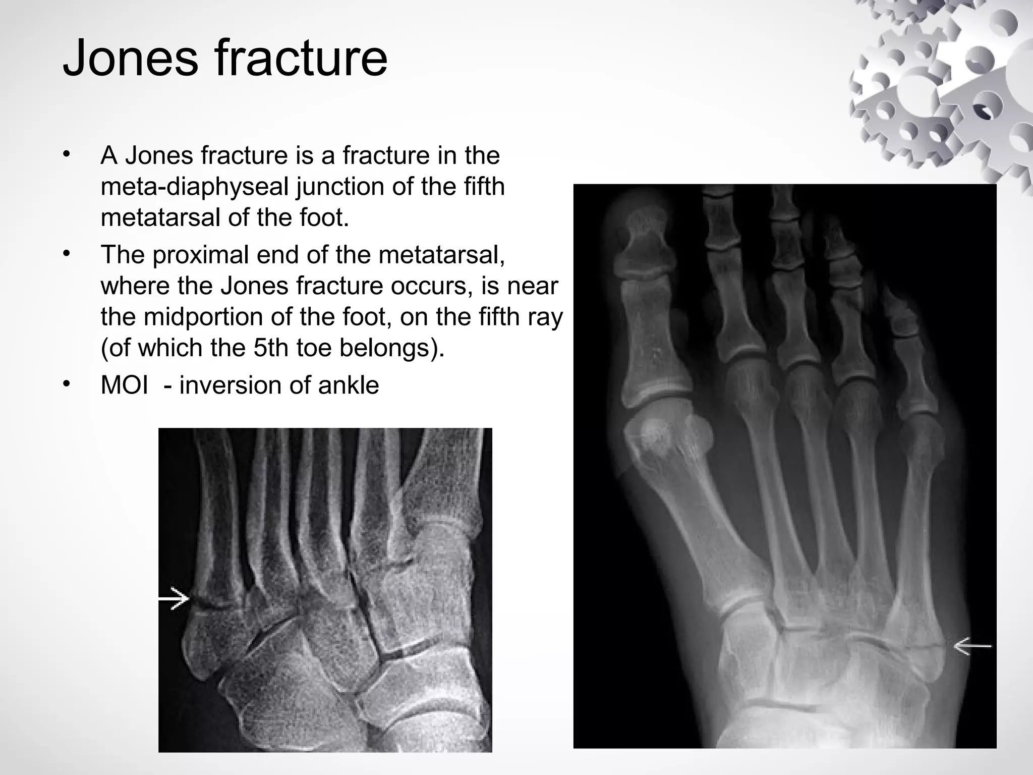 Eponymous fractures | PPT
