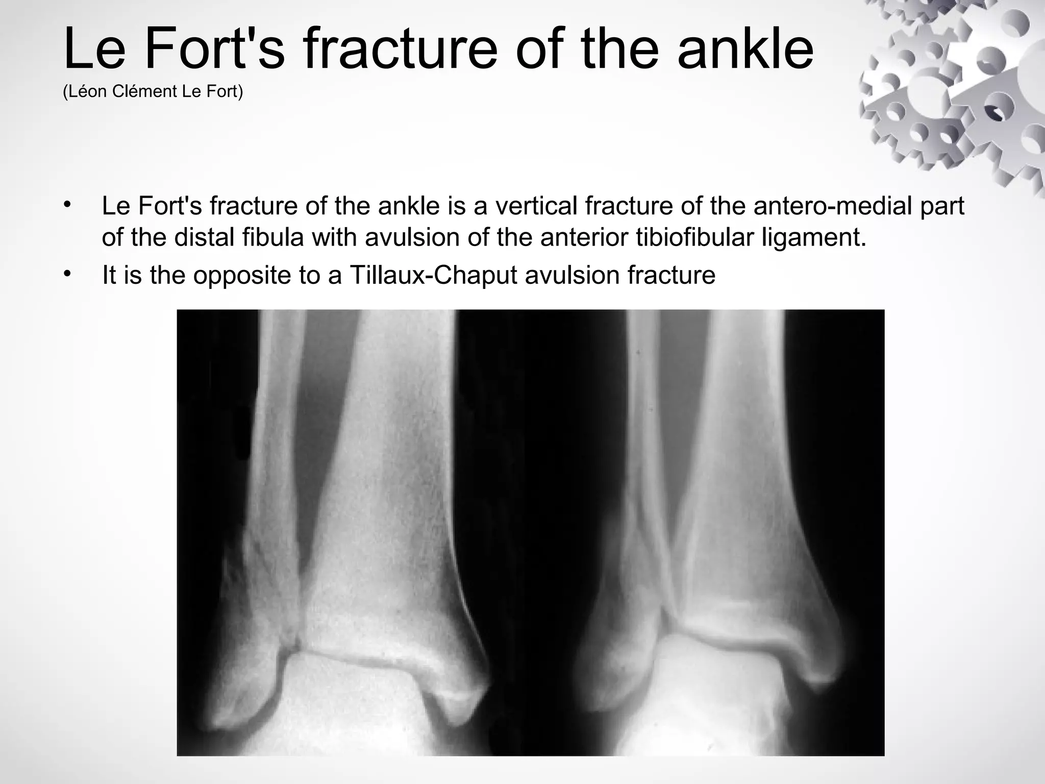 Eponymous fractures | PPT