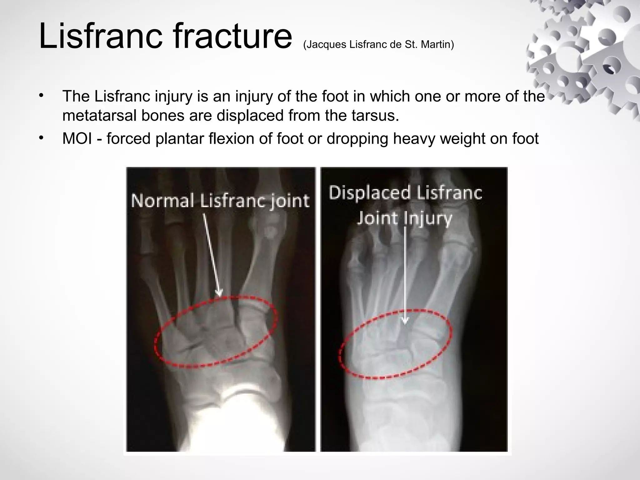 Eponymous fractures | PPT