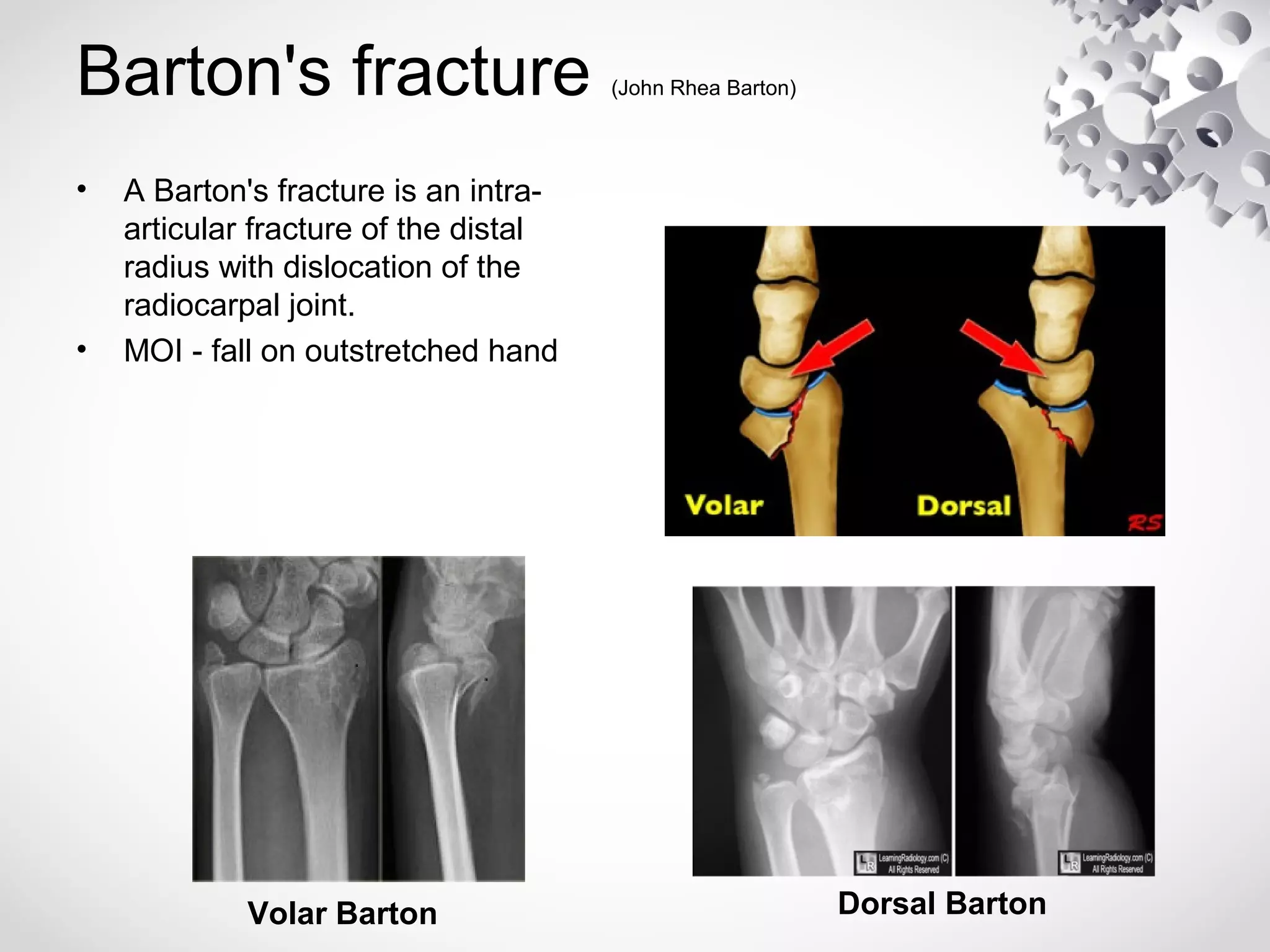 Eponymous fractures | PPT