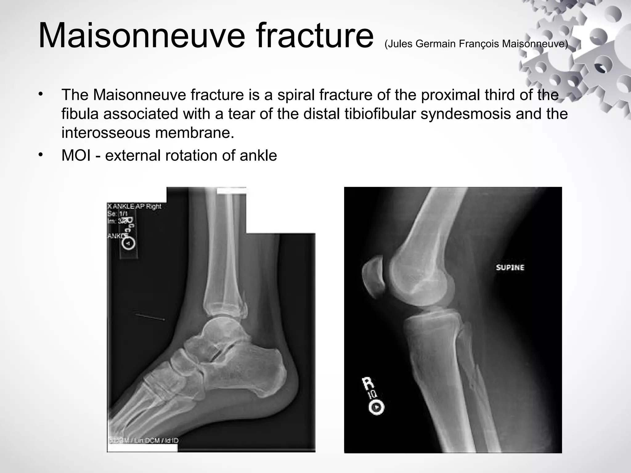 Eponymous fractures | PPT