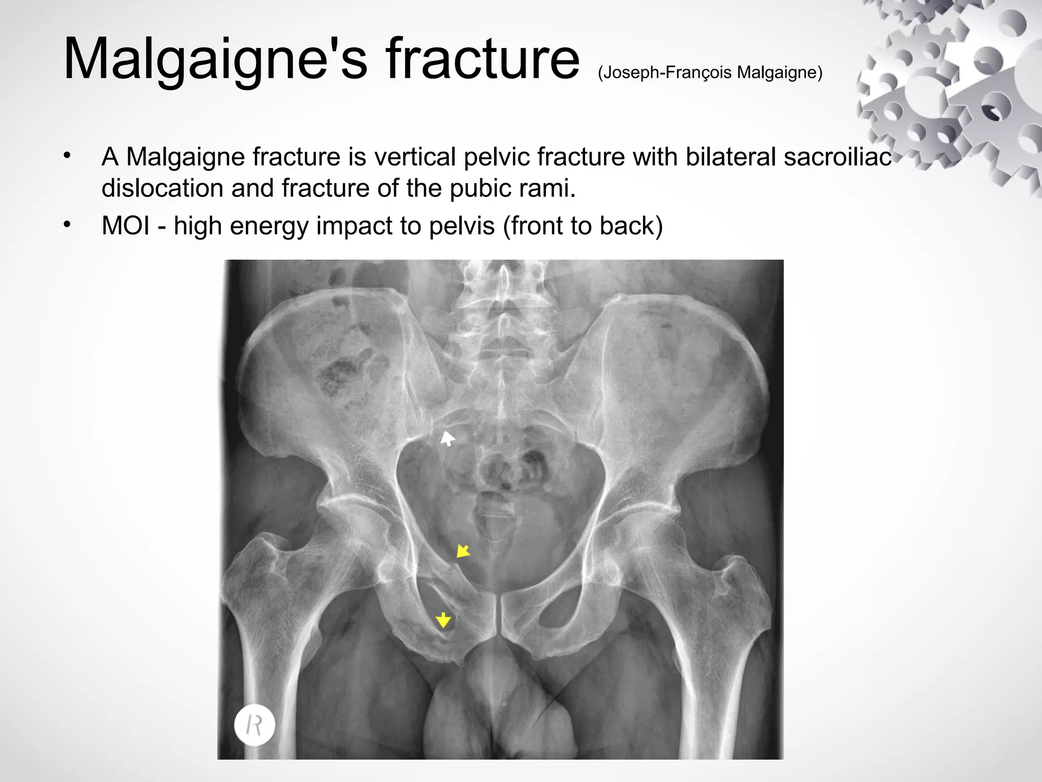 Eponymous fractures | PPT