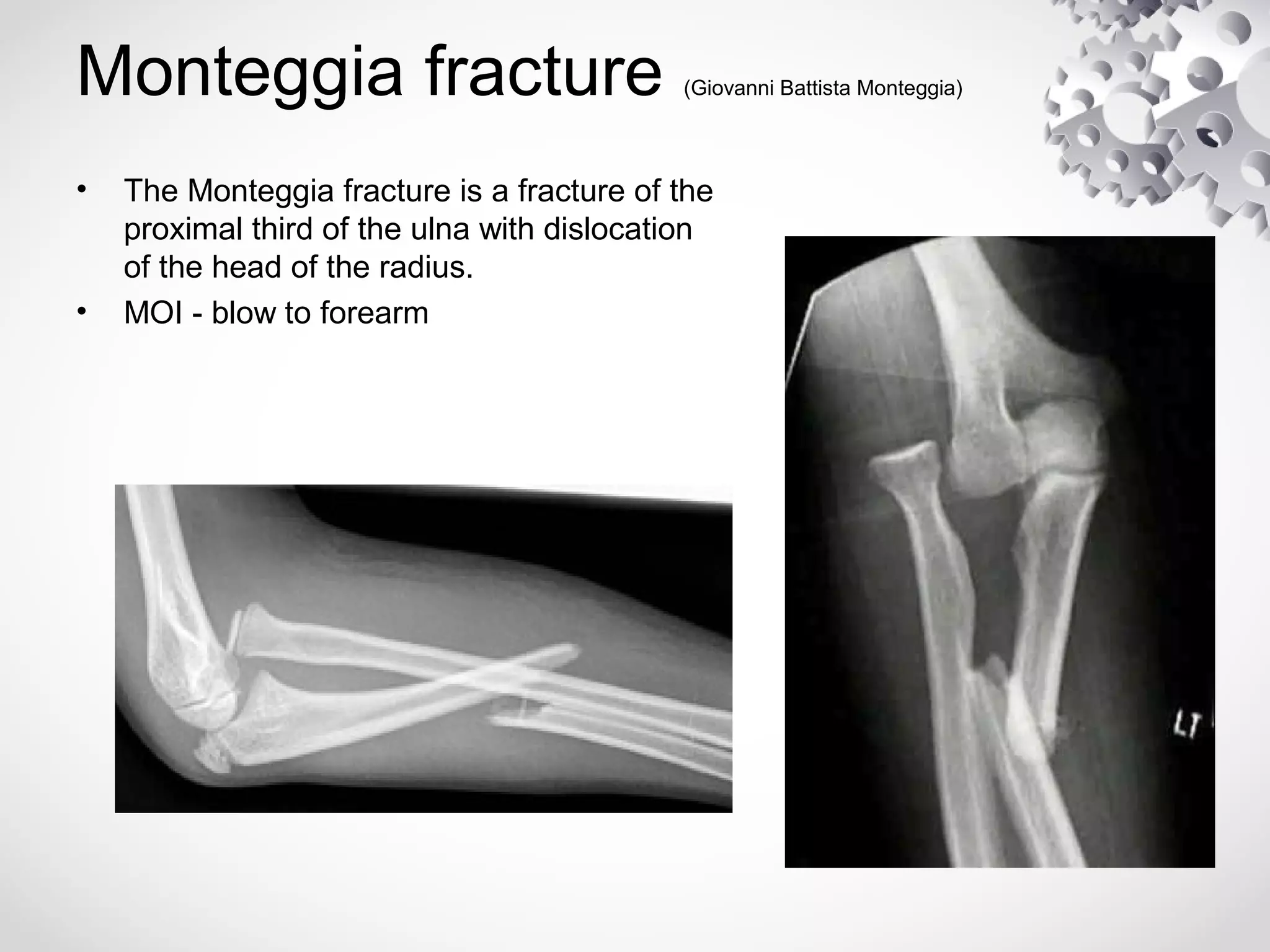 Eponymous fractures | PPT