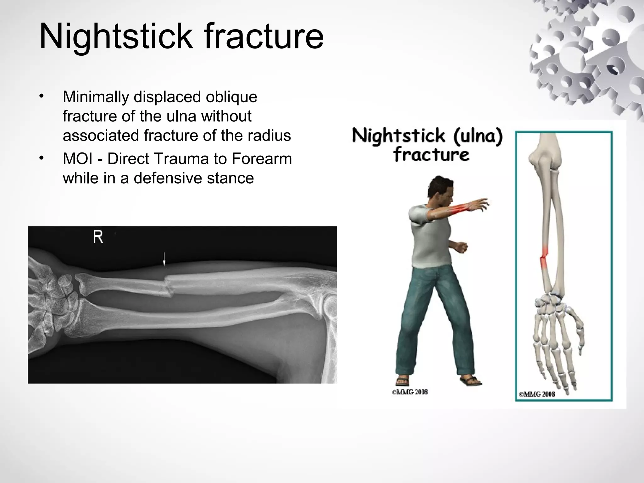 Eponymous fractures | PPT