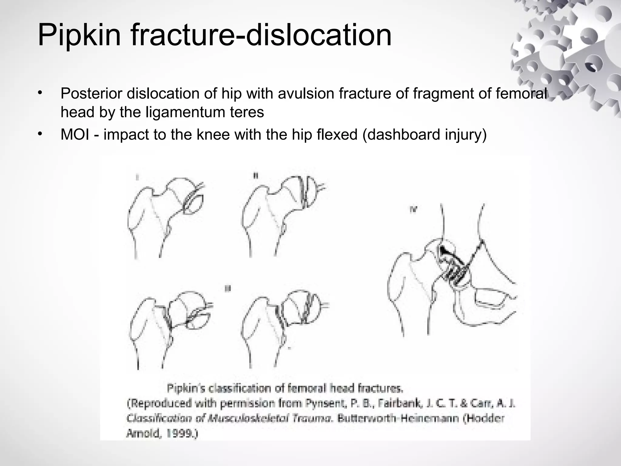 Eponymous fractures | PPT