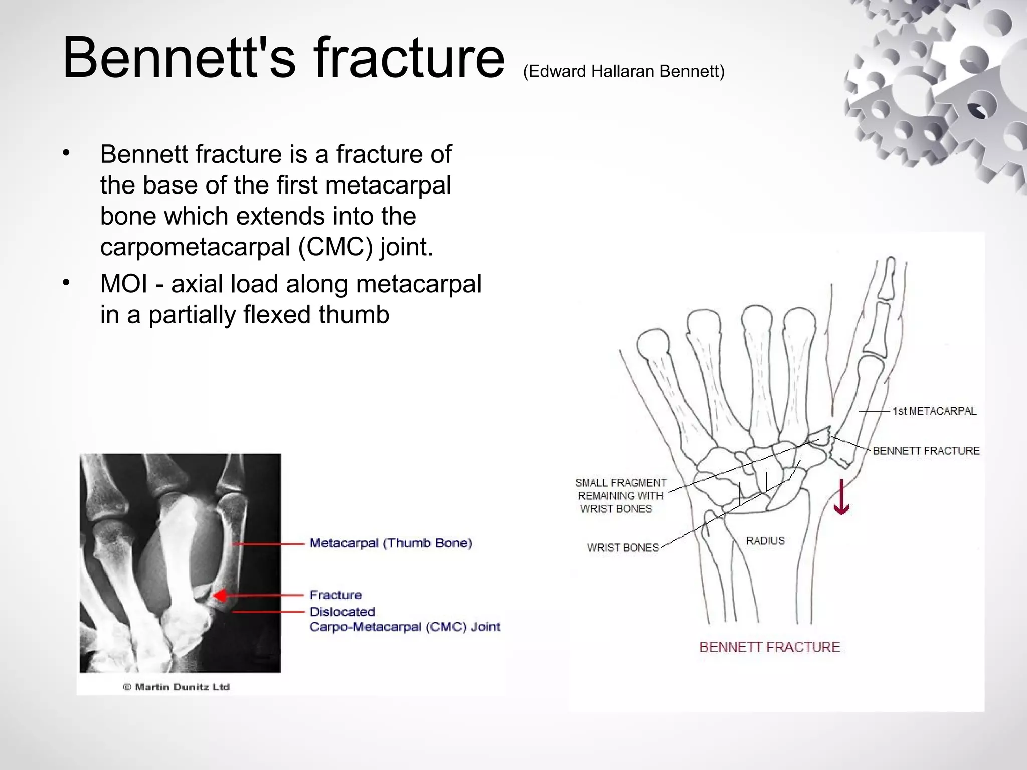 Eponymous fractures | PPT