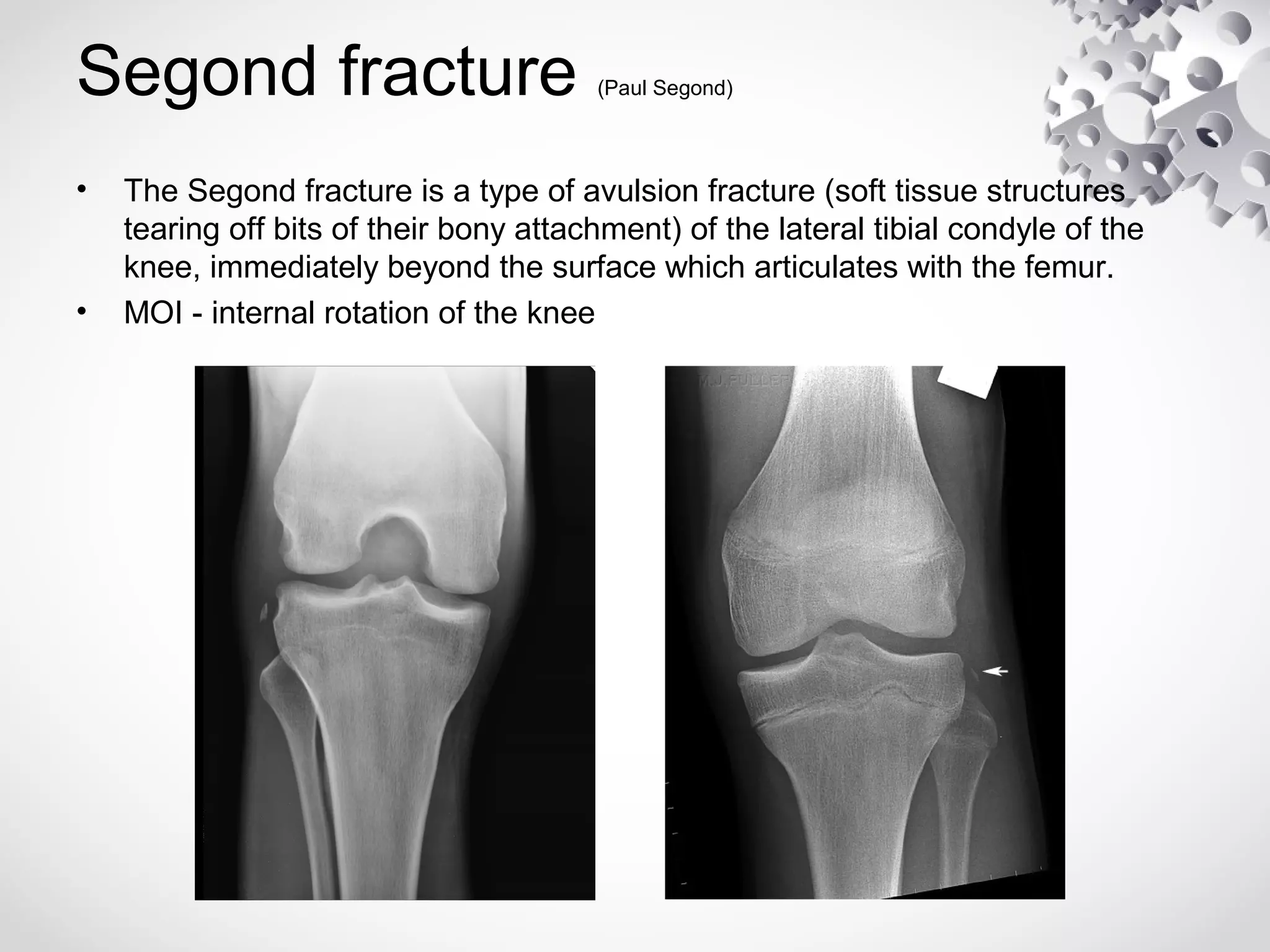 Eponymous fractures | PPT