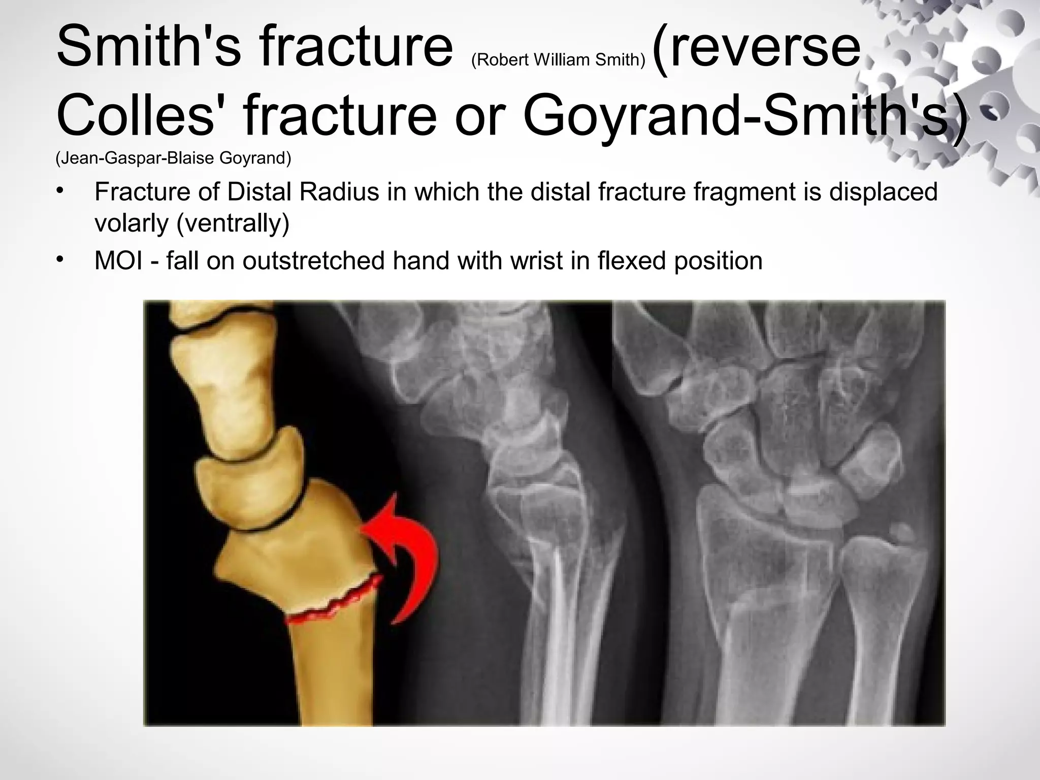 Eponymous fractures | PPT