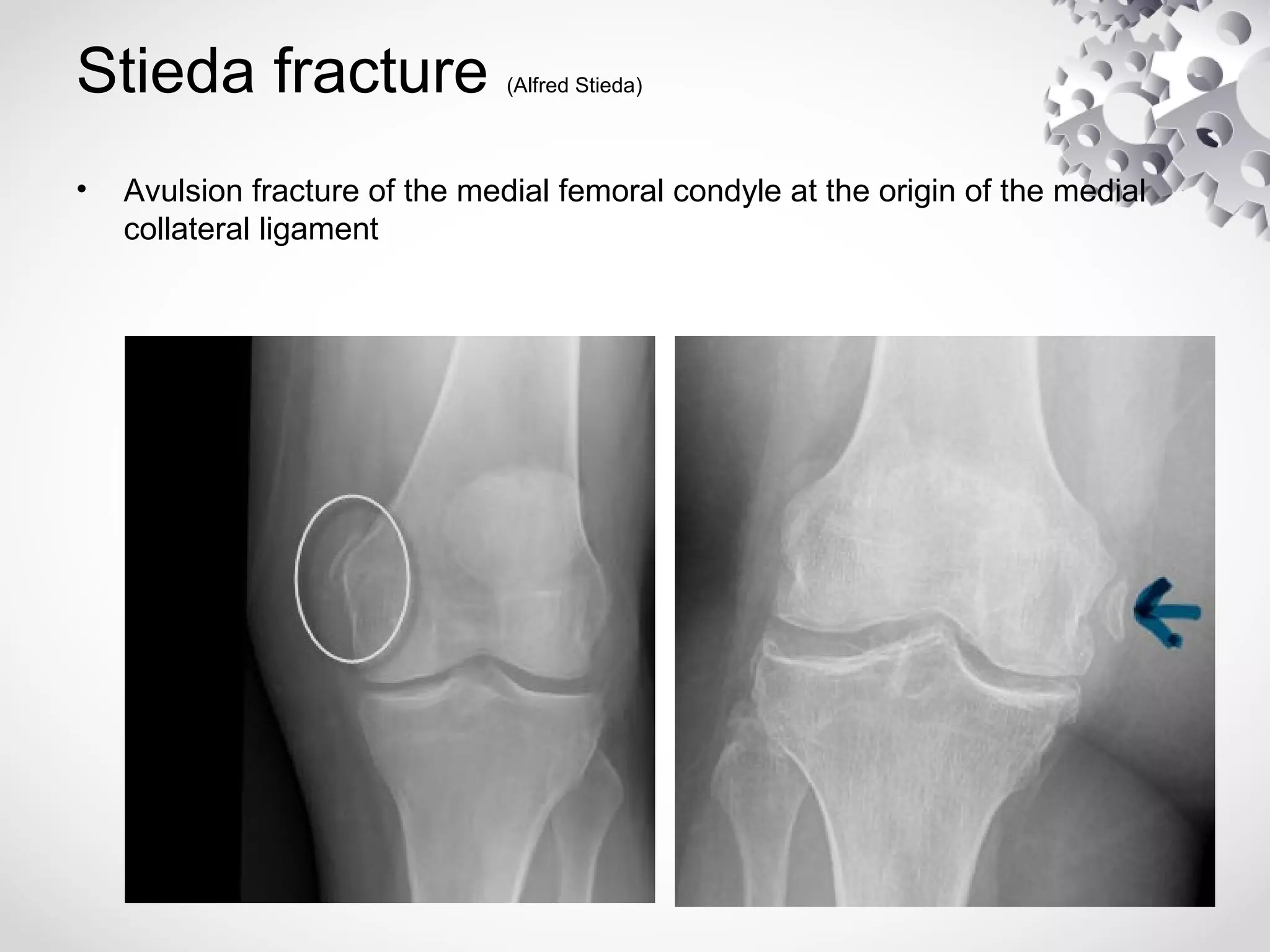 Eponymous fractures | PPT