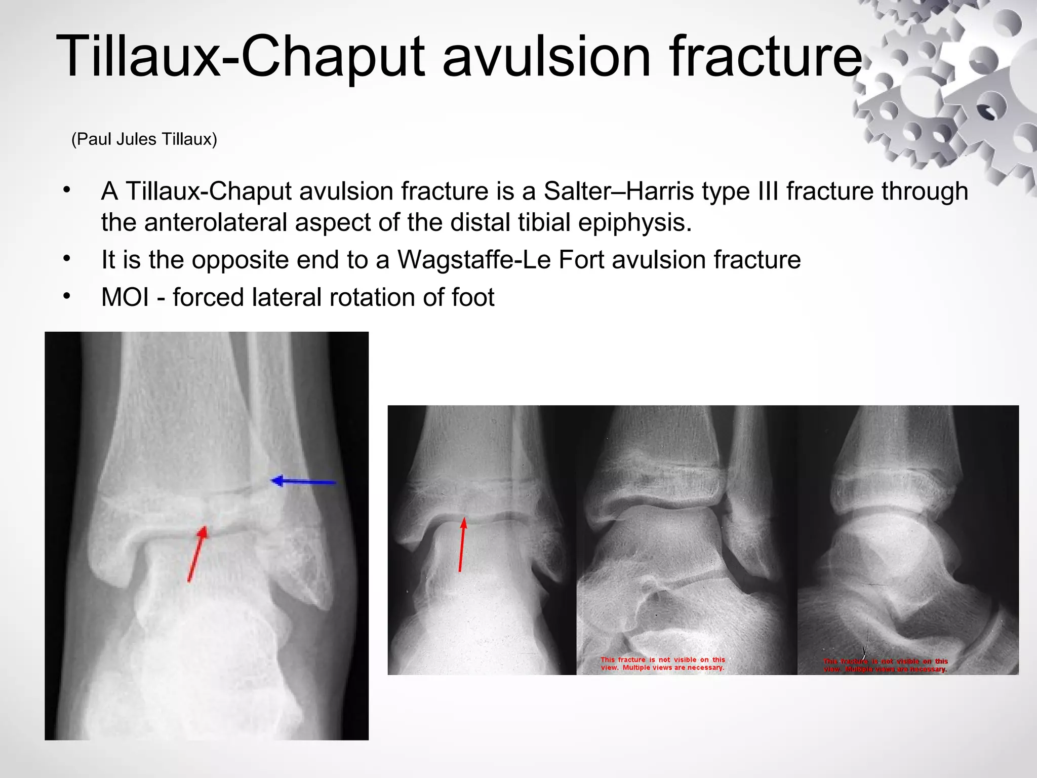 Eponymous fractures | PPT
