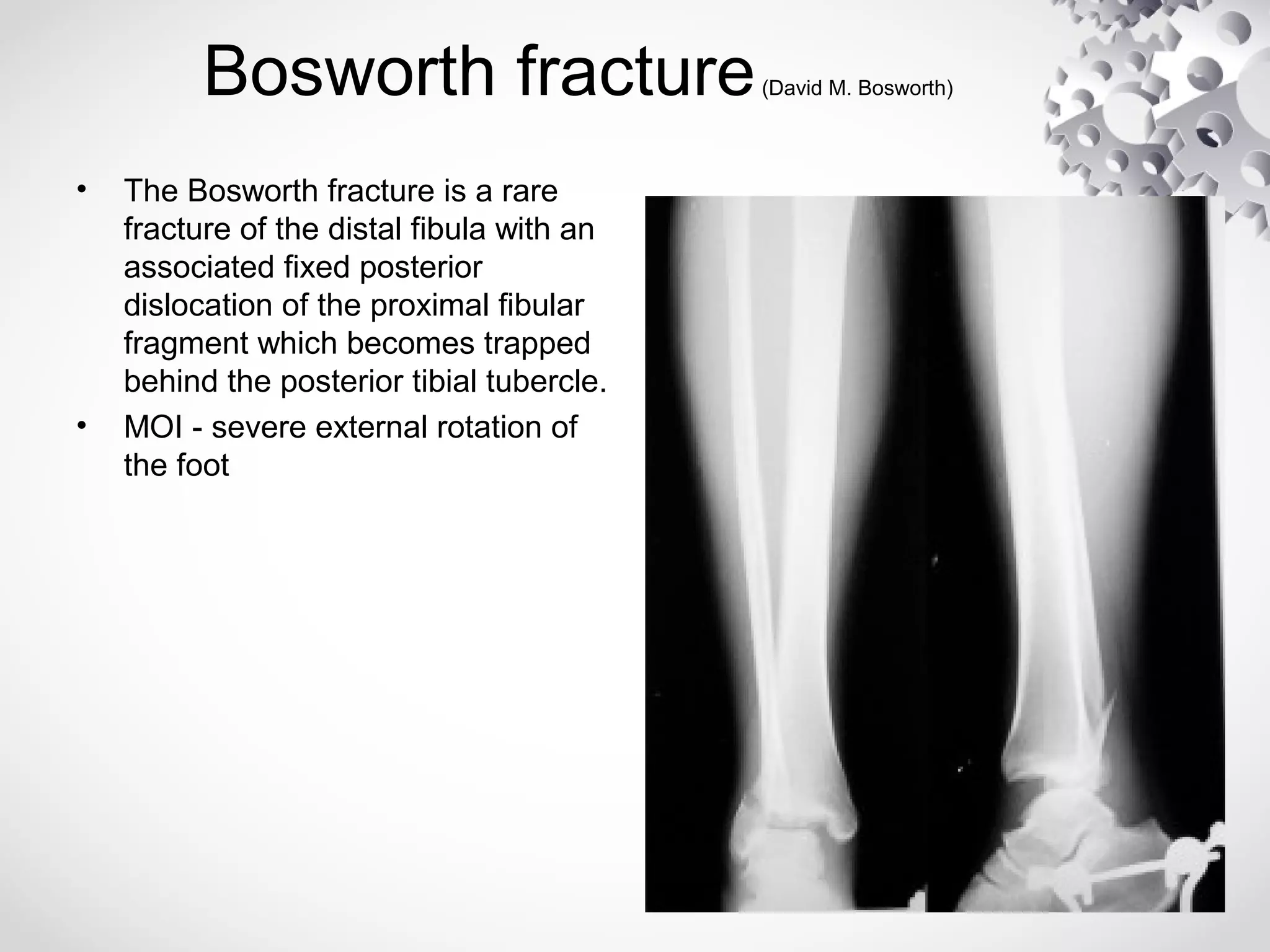 Eponymous fractures | PPT