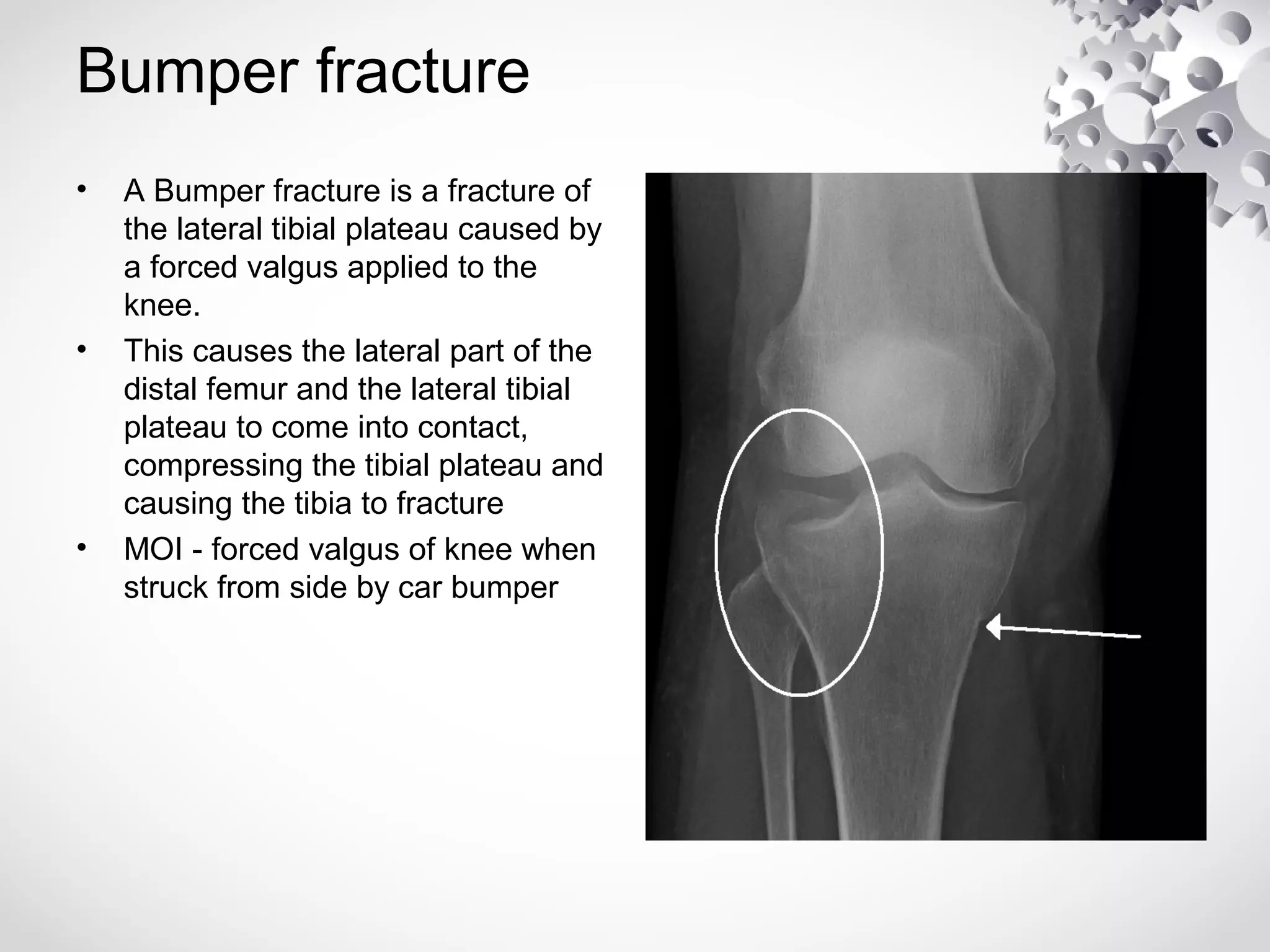 Eponymous fractures | PPT