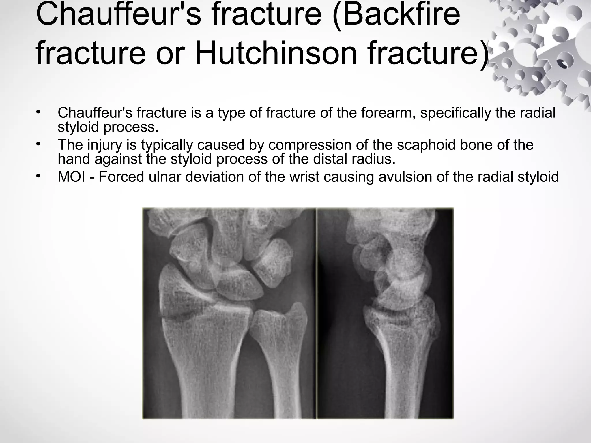 Eponymous fractures | PPT