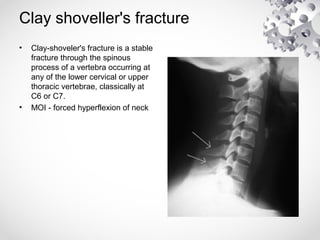 Eponymous fractures | PPT