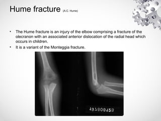 Eponymous fractures | PPT