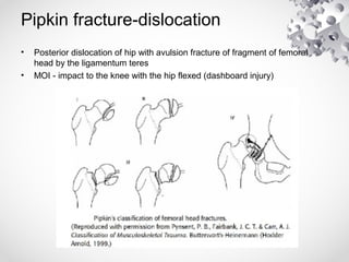 Eponymous fractures | PPT