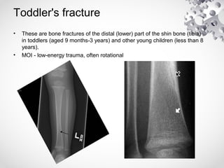 Eponymous fractures | PPT