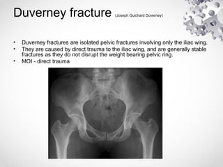 Duverney Fracture