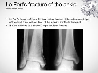 Le Fort Fracture Of Ankle