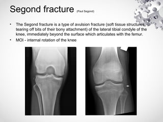 Bumper Fracture