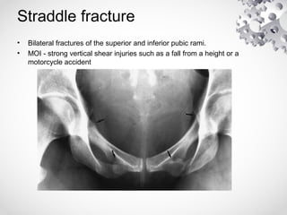 Straddle Fracture