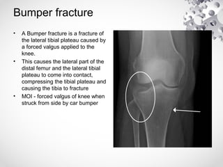 Bumper Fracture
