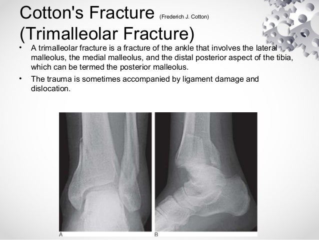 Eponymous fractures
