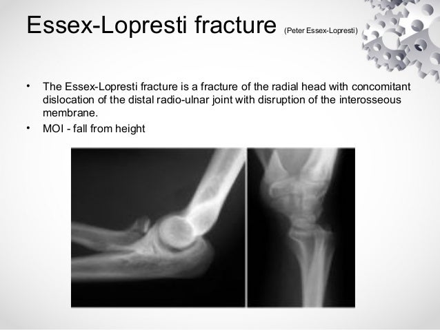 Eponymous fractures