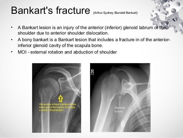 Bankart Fracture