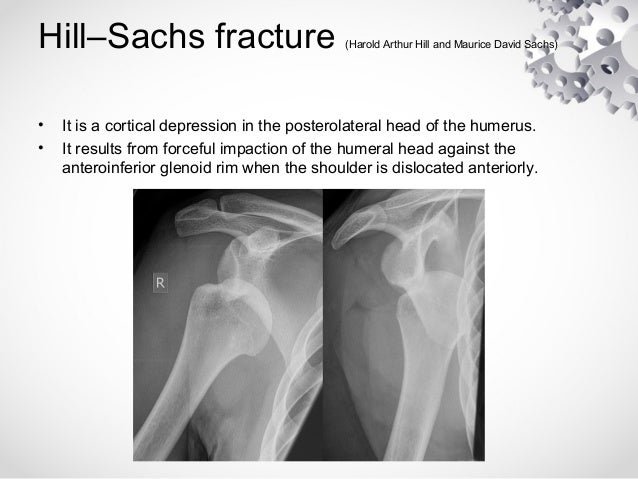 Eponymous fractures