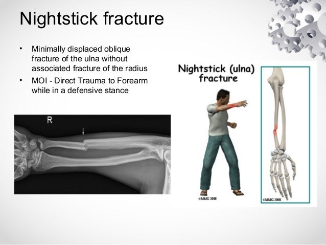 Eponymous fractures