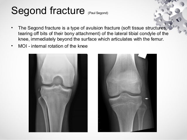 Eponymous fractures