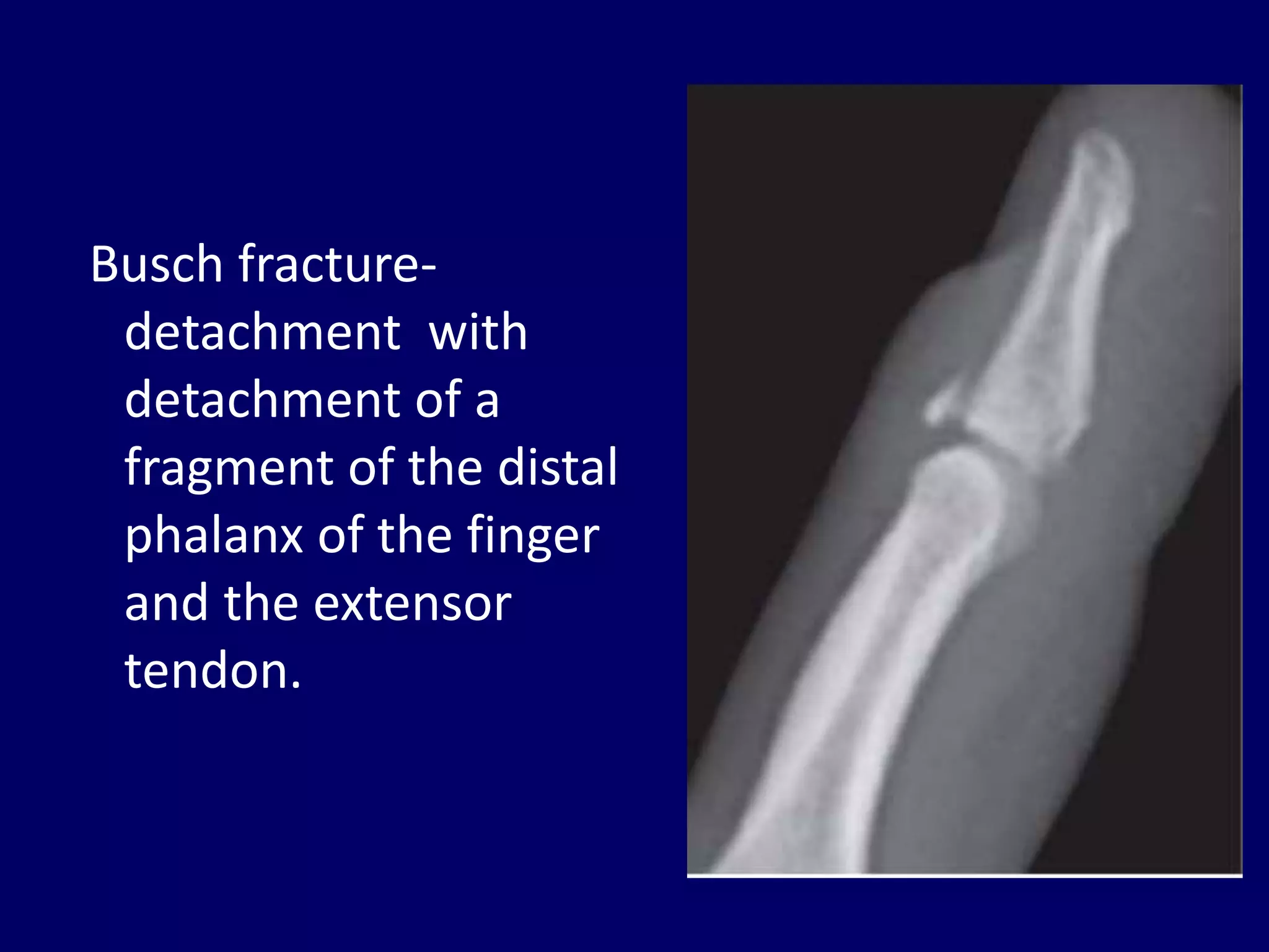 Eponymous fractures name Dr. muhammad Bin Zulfiqar | PPTX