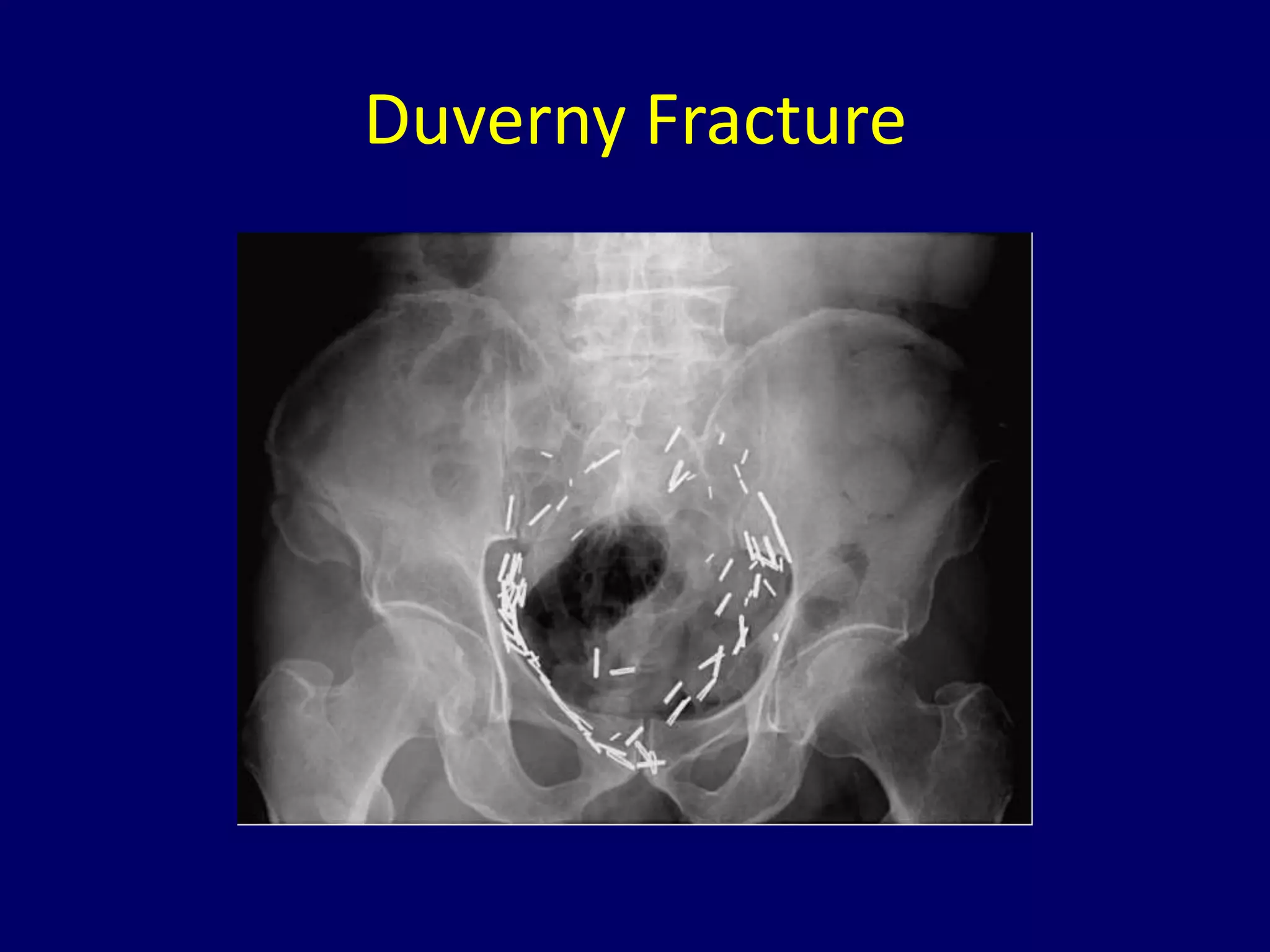 Eponymous fractures name Dr. muhammad Bin Zulfiqar | PPTX