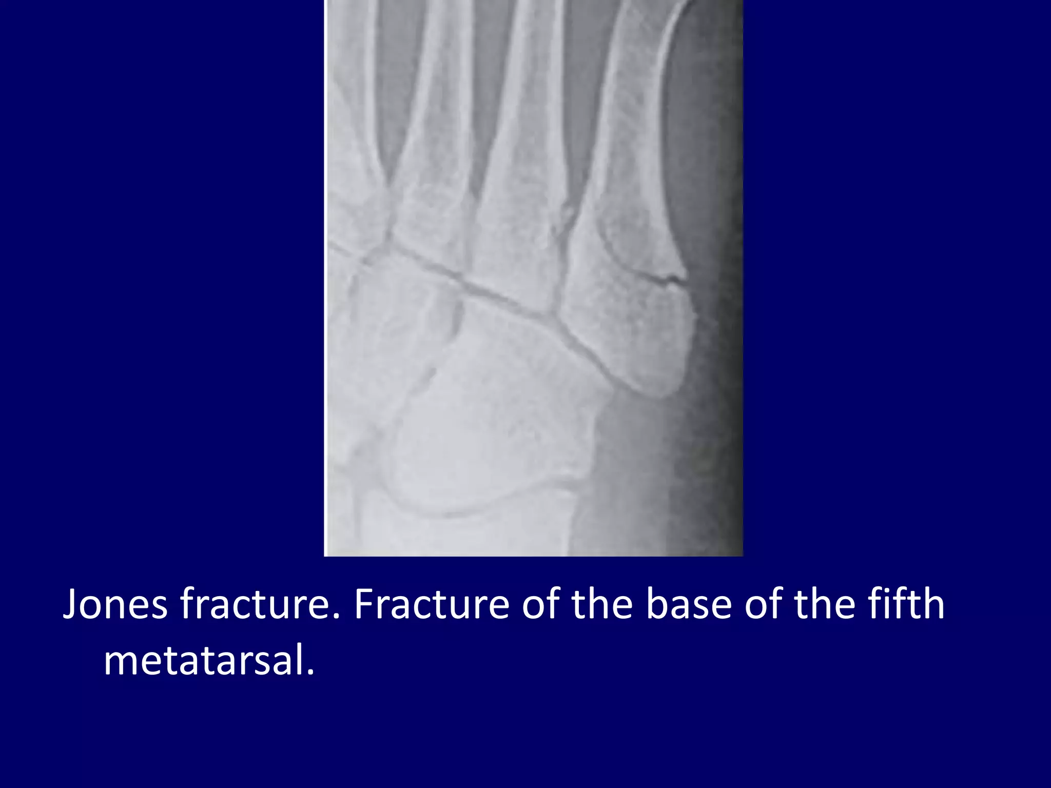 Eponymous fractures name Dr. muhammad Bin Zulfiqar | PPTX
