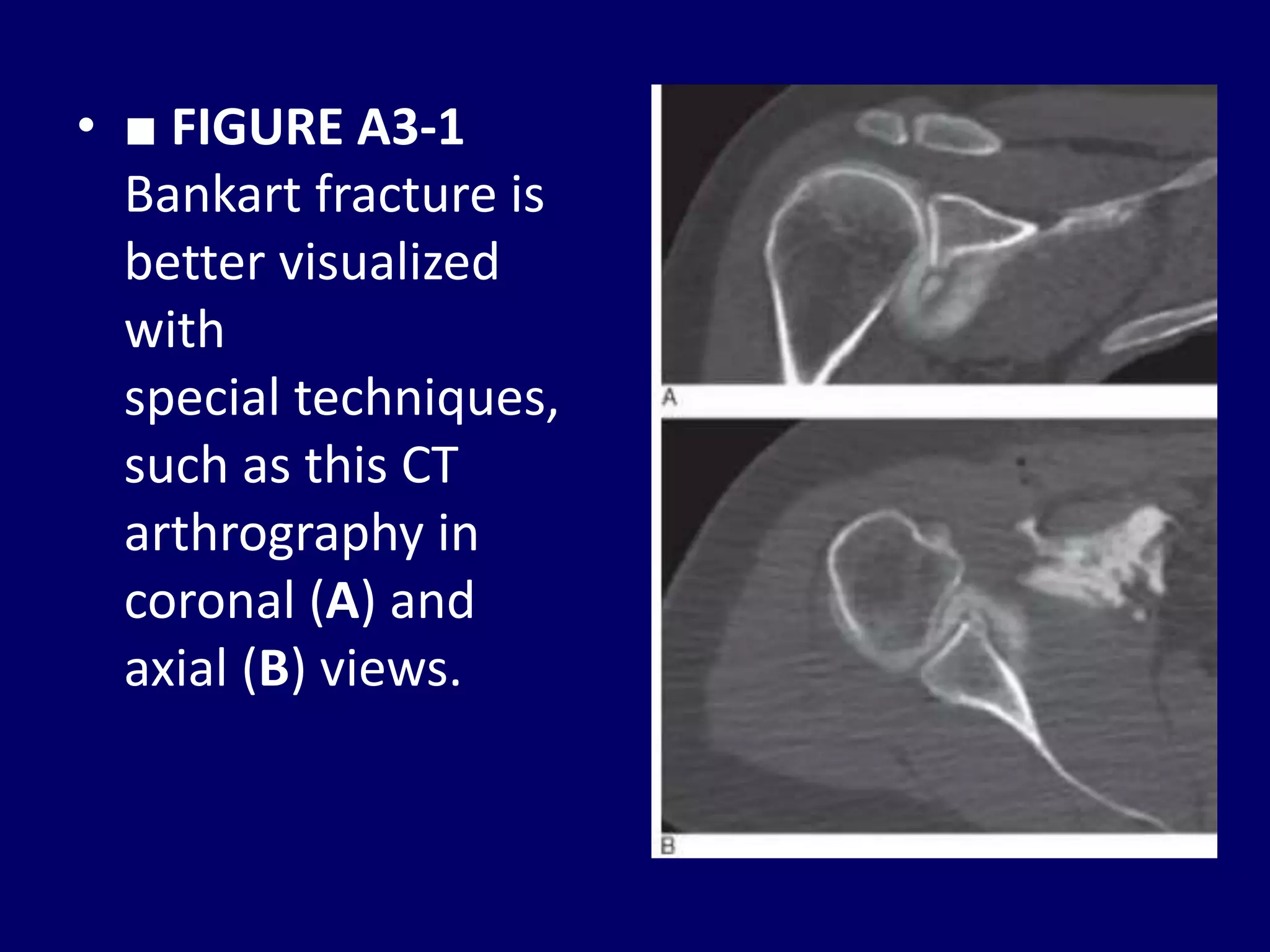 Eponymous fractures name Dr. muhammad Bin Zulfiqar | PPTX
