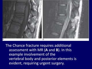 Eponymous fractures name Dr. muhammad Bin Zulfiqar | PPTX