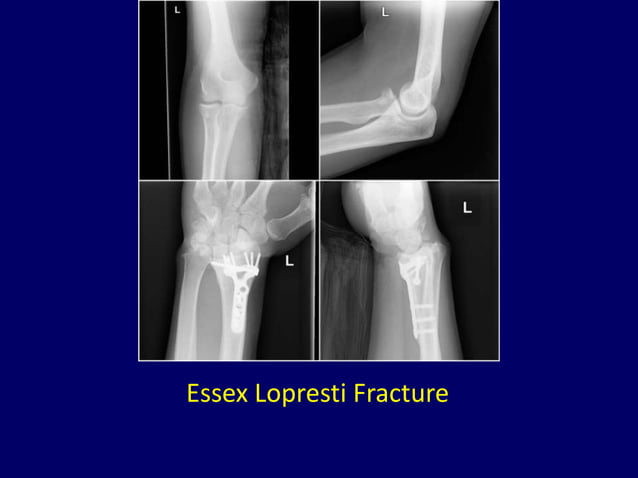Eponymous fractures name Dr. muhammad Bin Zulfiqar | PPTX