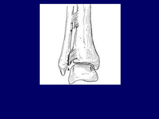 Eponymous fractures name Dr. muhammad Bin Zulfiqar | PPTX
