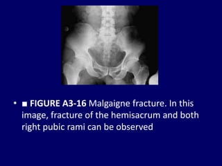 Eponymous fractures name Dr. muhammad Bin Zulfiqar | PPTX