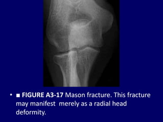 Eponymous fractures name Dr. muhammad Bin Zulfiqar | PPTX