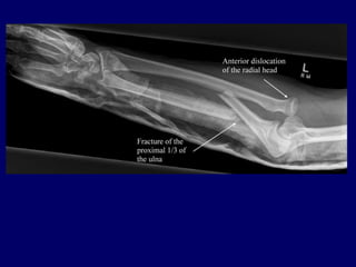 Eponymous fractures name Dr. muhammad Bin Zulfiqar | PPTX