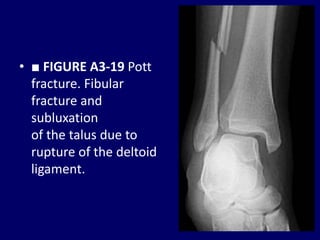 Eponymous fractures name Dr. muhammad Bin Zulfiqar | PPTX