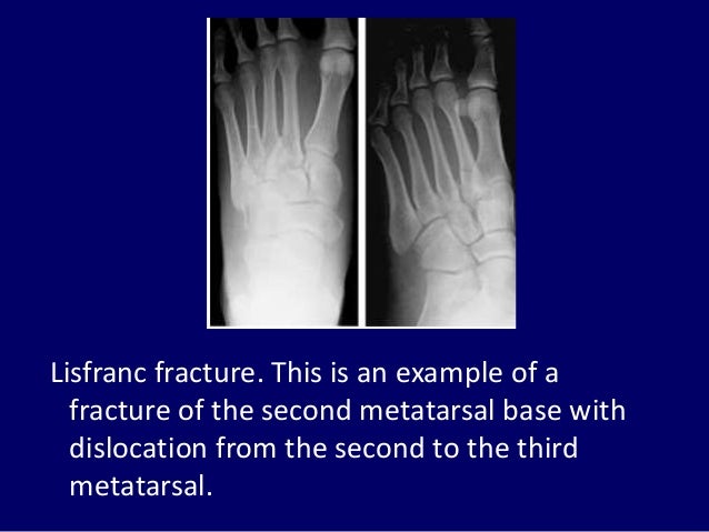 Eponymous Fractures Name Dr Muhammad Bin Zulfiqar Strategic Studies