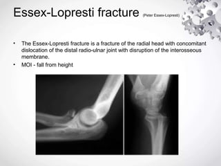 Eponyms in orthopaedics - fractures.pptx
