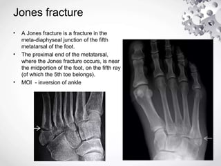 Eponyms in orthopaedics - fractures.pptx