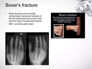 Eponyms in orthopaedics - fractures.pptx