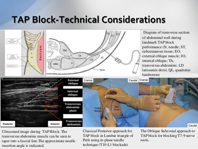Severe Kyphoscoliosis with Inguinal Swelling excision underUSG guided…