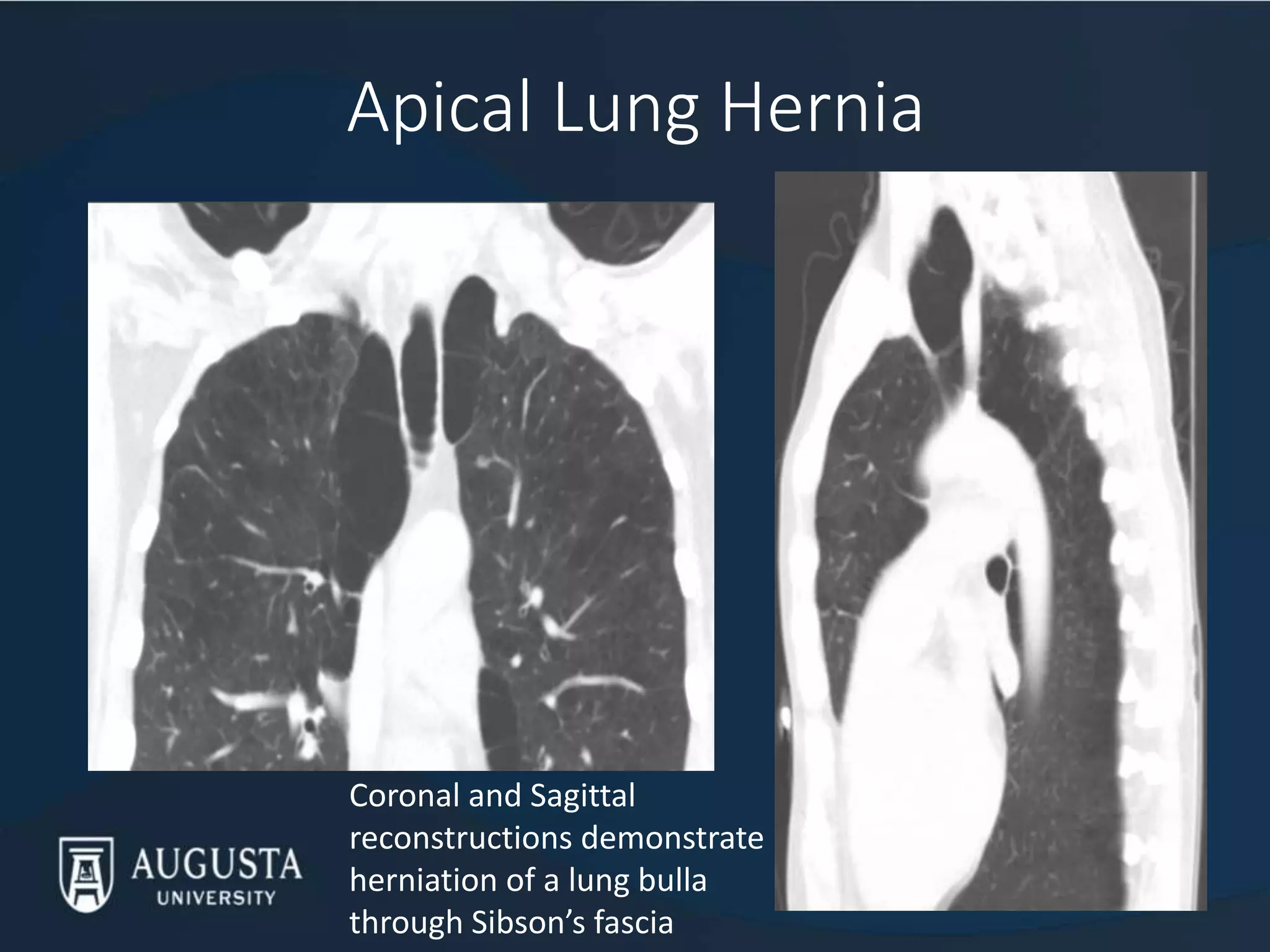 Interesting cases of lung hernias | PPTX